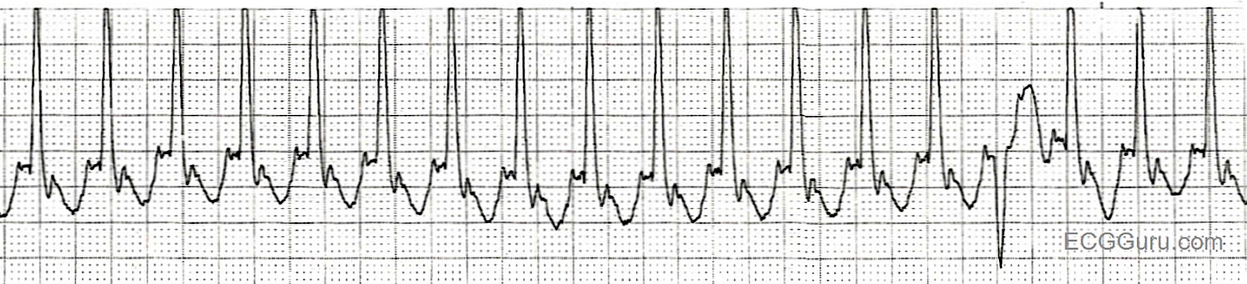 Atrial Flutter With 2 1 Conduction Ecg Guru Instructor Resources